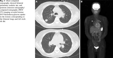 Chest Computed Tomography Showed Bilateral Pulmonary Nodules A And Download Scientific