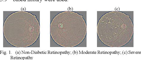 Figure From Diabetic Retinopathy Image Classification Using Machine Learning And Local Binary