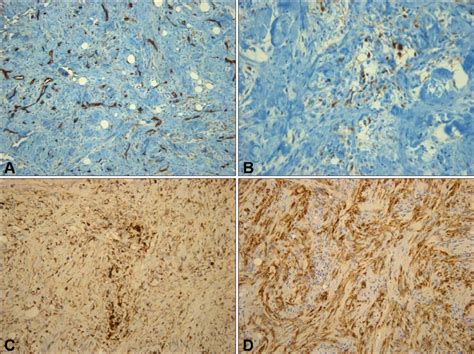 A Case Of Dermatofibroma Of The Upper Lip