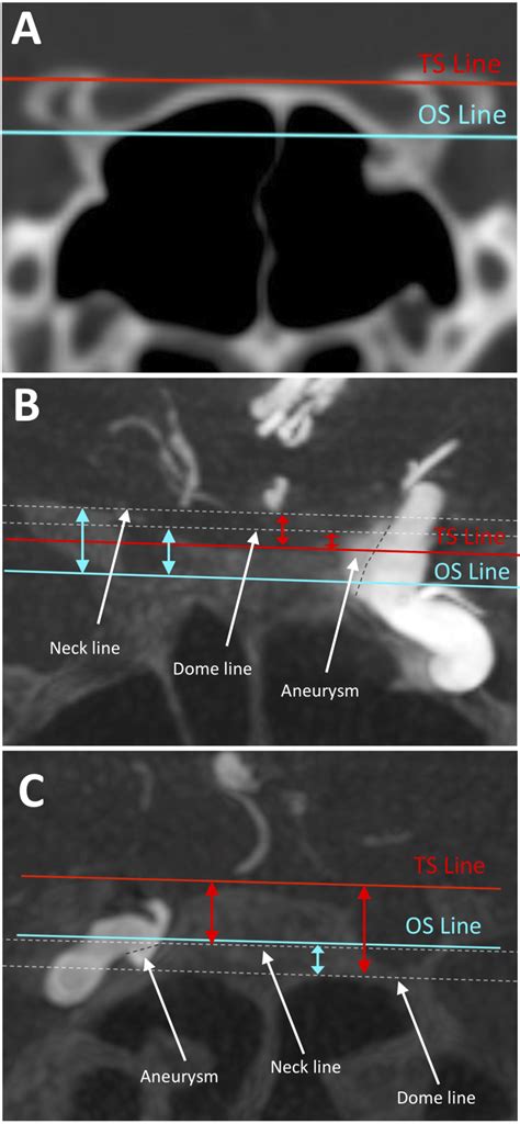 Anatomical Considerations Of The Paraclinoid Region In A Coronal View