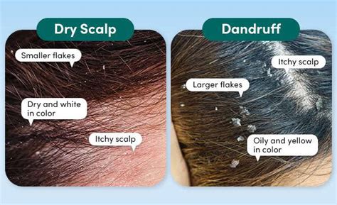 How To Avoid Dry Or Flaky Scalp Healu