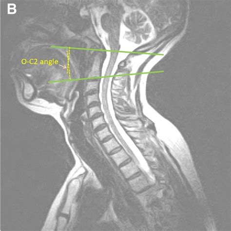 The Mean Value Of Disc Degeneration In Four Group Of Cervical Sagittal
