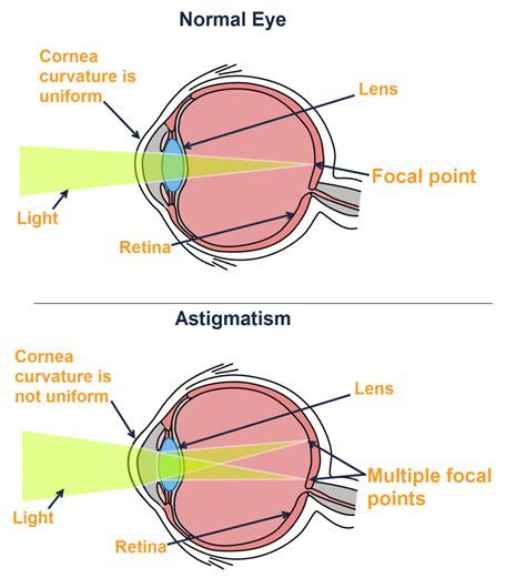 Astigmatism Explained Clearly Causes Symptoms And Effective Treatments Eye Expressions