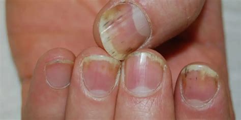 Nail Psoriasis Severity Index Napsi What It Is What It Measures