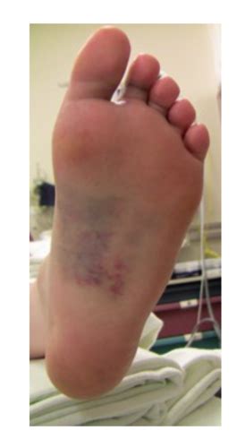 Acute Ankle Injuries Flashcards Quizlet