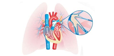 Cteph And Treatment Options Bel Air Center