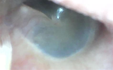 Is This A Normal Ear Drum Rearwax