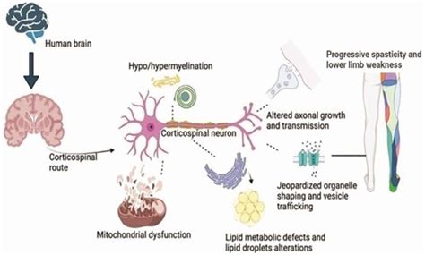 Hereditary Spastic Paraplegia Causes Symptoms Diagnosis Treatment