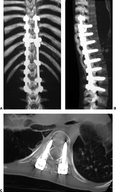 Idiopathic Scoliosis Teachme Orthopedics