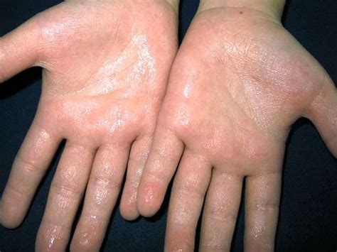 Ra Nhiều Mồ Hôi Tay Chân Khi Trời Lạnh Là Bệnh Gì