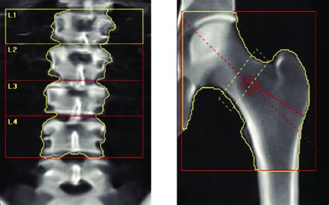Example Of High Resolution Dual Energy X Ray Absorptiometry Dxa