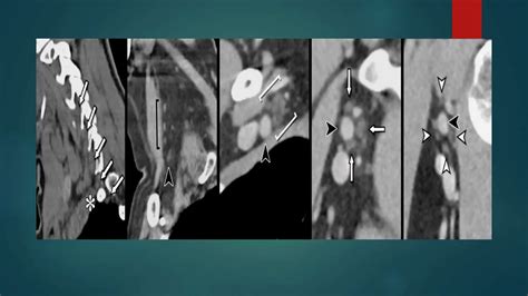 Imaging Of Brachial Plexus Radiology Pptx Pptx