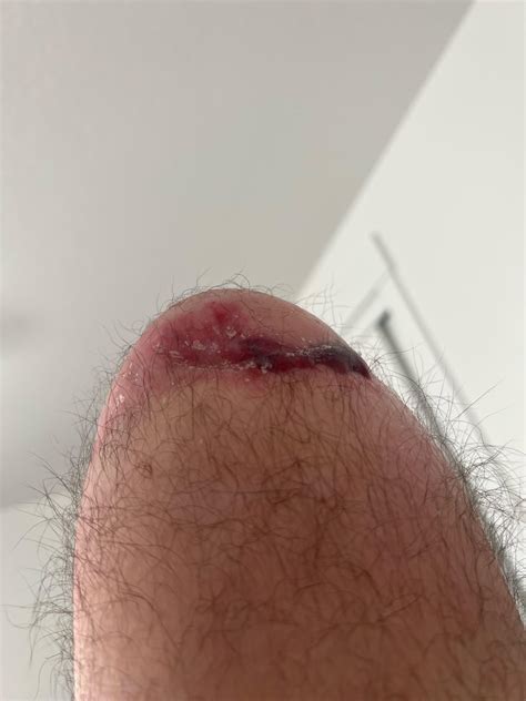 Who Has Met Their So After Their Amputation Dating Advice Ramputee