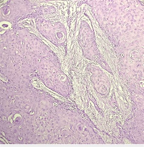 Hematoxylin And Eosin Stained Photomicrograph Of Squamous Cell