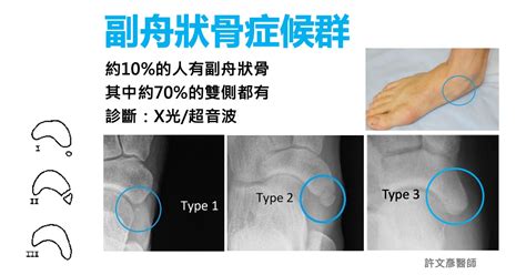 許文彥 醫師 副舟狀骨症候群