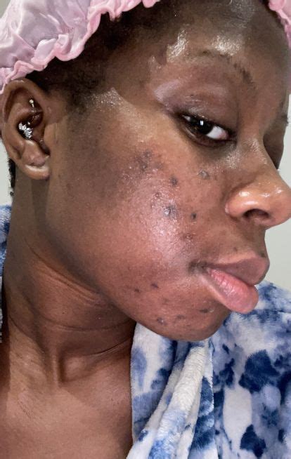 Tretinoin Cream Before And After Acne