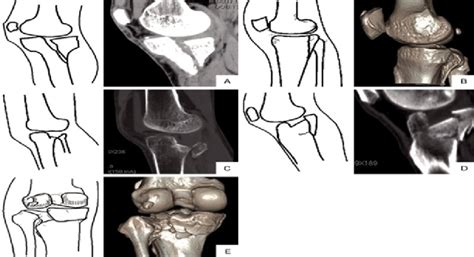Diagrammatic Sketch Showing Five Fracture Patterns Of Posterior Tibial