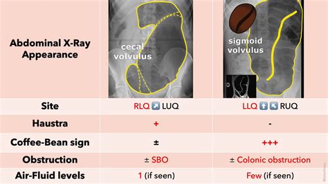 Cecal Volvulus
