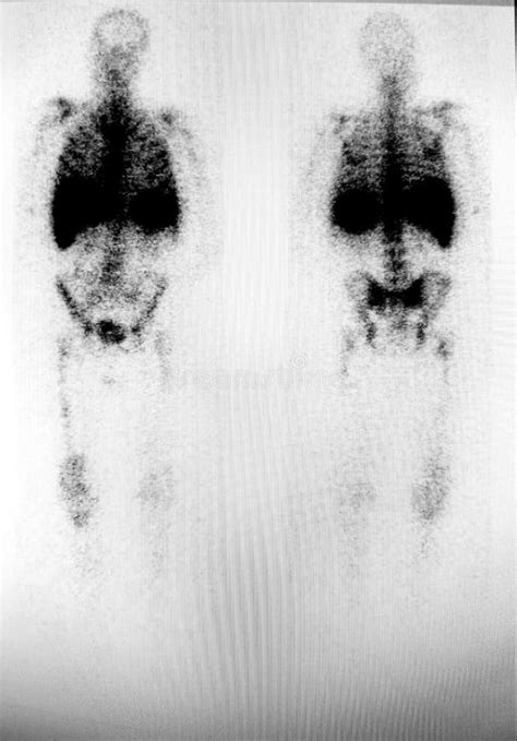 Indium Labeled Wbc Scan Images Right Prosthetic Knee Infection Stock
