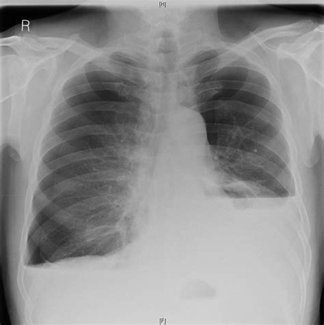 Simultaneous Bilateral Secondary Pneumothorax Complicating Osteosarcoma