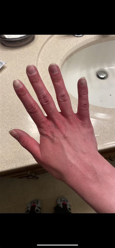 After Years Of Having Suspiciously Warm And Red Hands I Think I Have