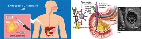 Дурангийн хэт авиан шинжилгээ Endoscopic Ultrasound Eus Intermed Hospital Интермед эмнэлэг