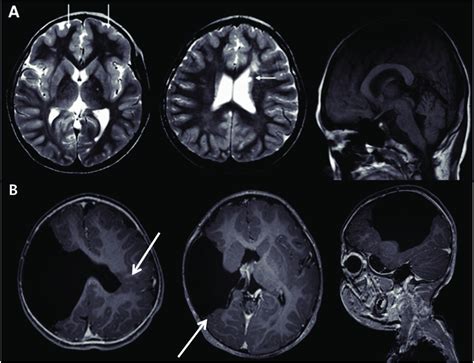 Polymicrogyria And Schizencephaly A Brain Magnetic Resonance Imaging Download Scientific