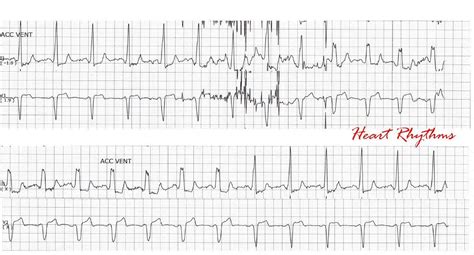 Ecg Rhythms Rate Dependent Left Bundle Branch Block