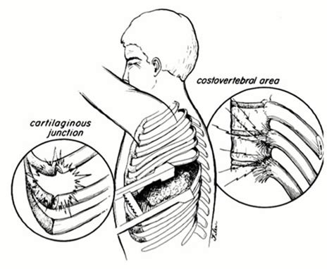 Thoracotomy