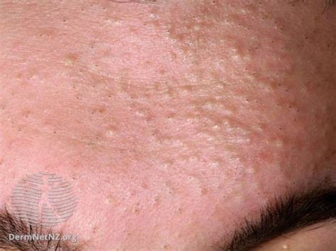 Comedonal Acne Symptoms Causes Treatment Prevention