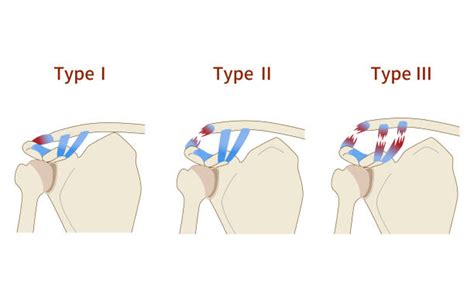 10 Coracoclavicular Ligament Foto Foto Stok Potret And Gambar Bebas