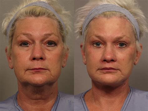 Total Facial Rejuvenation Facelift Browlift Upper Lip Lift Eyelid