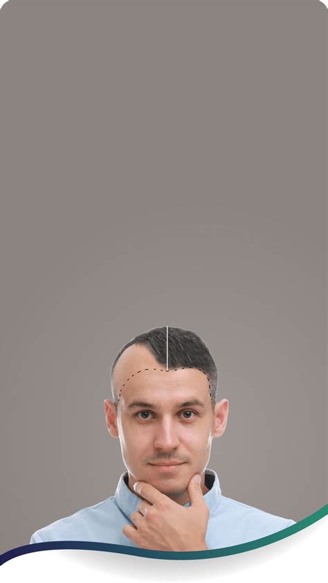 Top 194 Natural Hair Transplant Bangalore Bengaluru Karnataka
