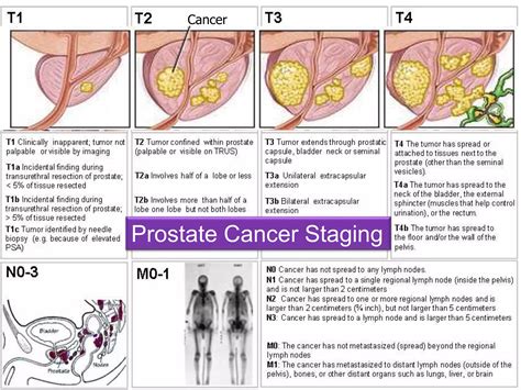 Pathology Lecture Neoplasia Pptx
