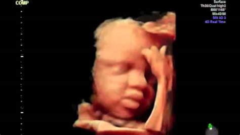 3d Echo 33 Weken Youtube
