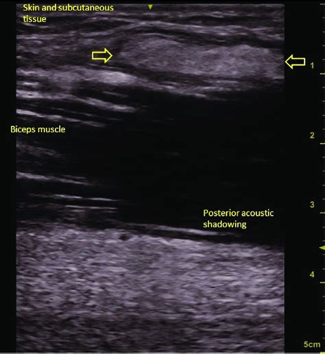 Musculoskeletal Ultrasound Of The Same Patient Of The Anterior Right