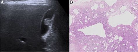 Polyp Based On Gastric Heterotopia With Dilated Glands Mimicking Cysts