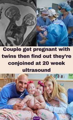 Couple Get Pregnant With Twins Then Find Out Theyre Conjoined At Week Ultrasound Twin