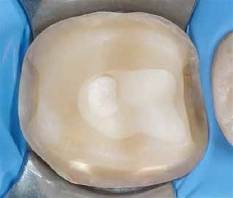 Anatomical Preparation Of The Occlusal Download Scientific Diagram
