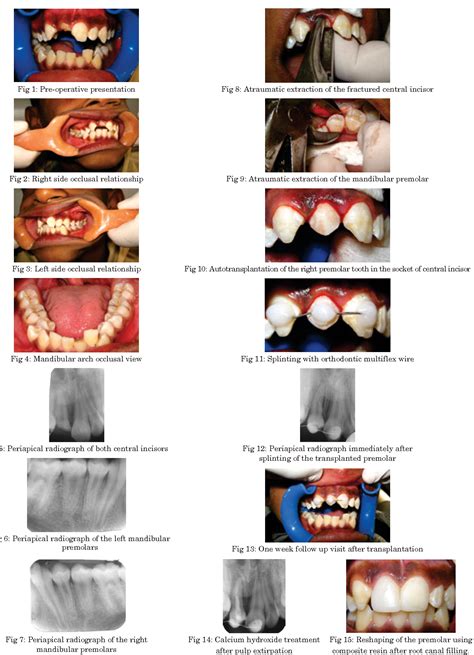 Figure 1 From IMMEDIATE AUTOTRANSPLANTATION OF PREMOLAR AS A TREATMENT