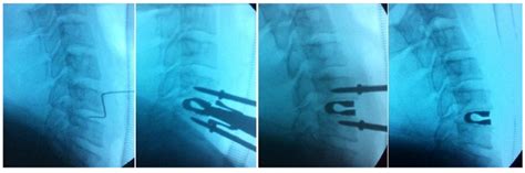 Intraoperative Fluoroscopic Images Showing Level Localization Download Scientific Diagram