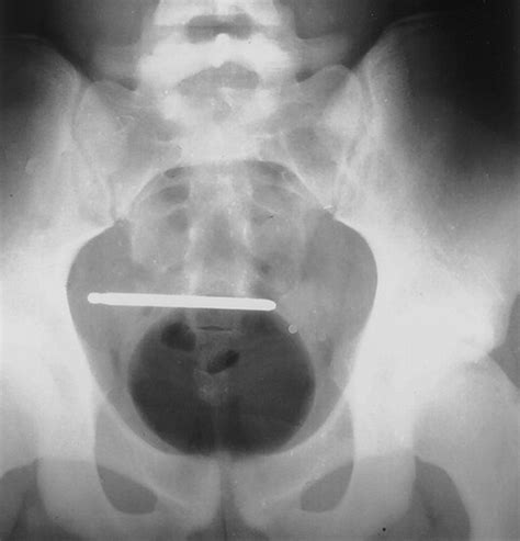 Anal Sex Xray Telegraph