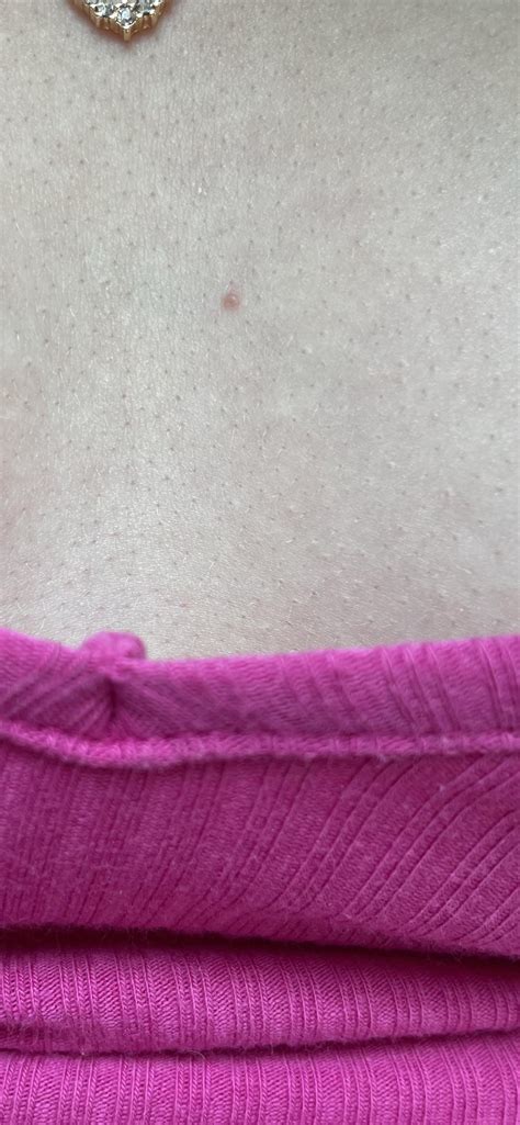 Had Mc On My Groin Derm Thinks They Removed The Last One A Few Weeks Ago Does This Look Like