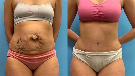 Breast Implants After Pregnancy Before And After