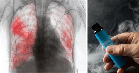 Revela Cofepris Riesgos Graves A La Salud Por Uso De Vapeadores