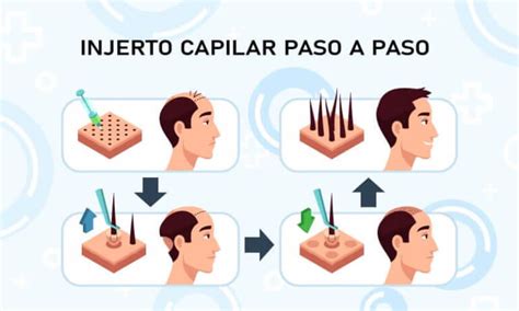 Los 5 pasos del Trasplante Capilar FUE invisible