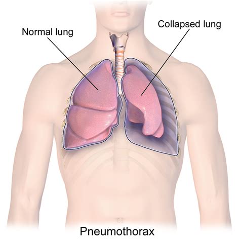 Difference Between Atelectasis And Pneumothorax Atelectasis Vs Pneumothorax