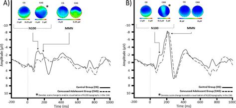 Grand Averaged Mmn Protocol Waveforms And Their Respective Scalp Download Scientific Diagram