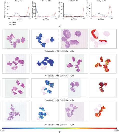 Preoperative Prediction Of Lymph Node Metastasis In Colorectal Cancer With Deep Learning Bme