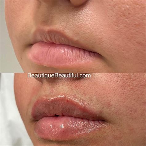 Best Lips In Knoxville Tn Beautique Medical Anti Aging